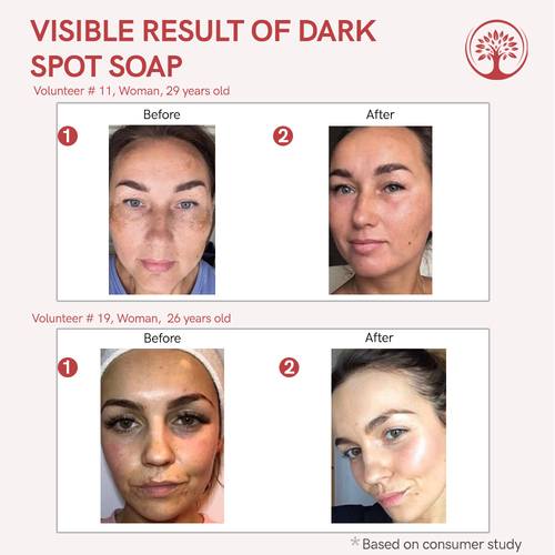 Buy Dark Spot Soap for Dark Spots Removal & Achieve Clear, Even-Toned Skin